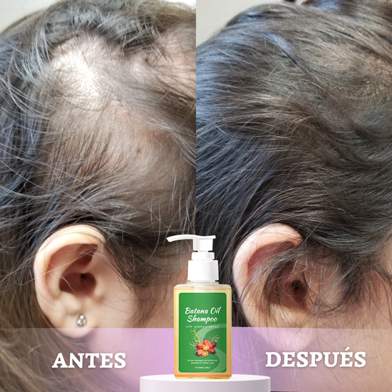 BATANA GOLD™ | DETÉN LA CAÍDA Y REVIVE TU CABELLO DESDE LA RAÍZ EN SOL ...